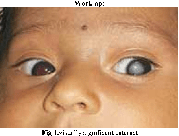 Understanding Congenital (Pediatric Cataract): Causes and Treatments