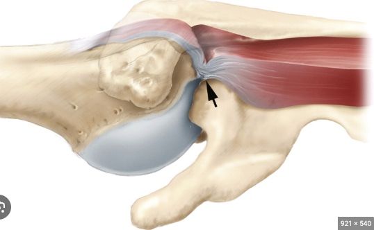 Shoulder Posterior Impingement Syndrome