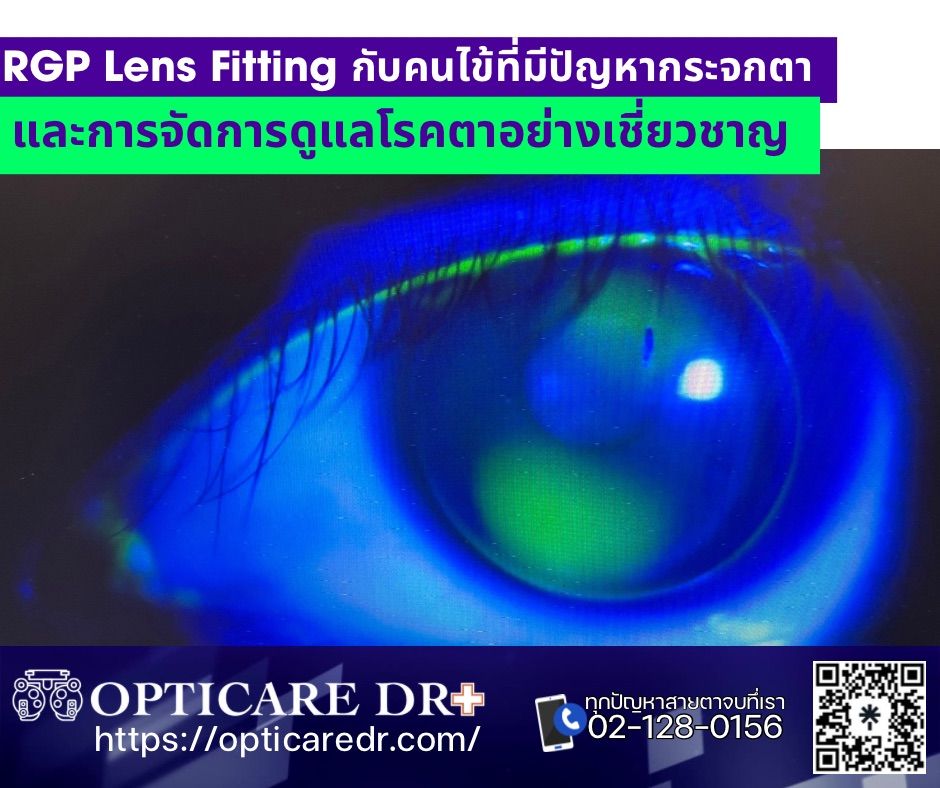RGP Lens Fitting กับคนไข้ที่มีปัญหากระจกตา และการจัดการดูแลโรคอย่าง ...