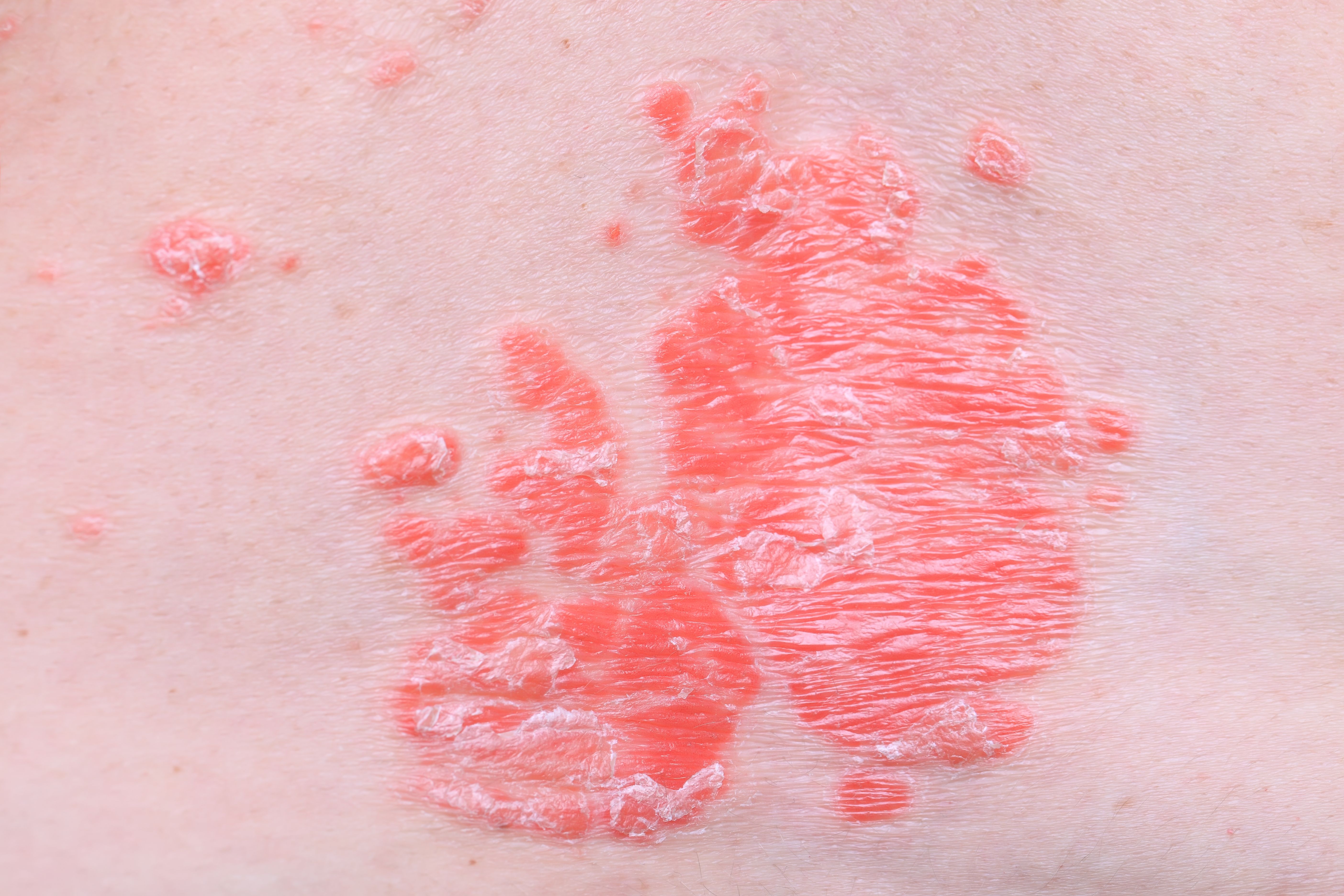 A Closer Look at Psoriasis Triggers: Local Environmental Factors