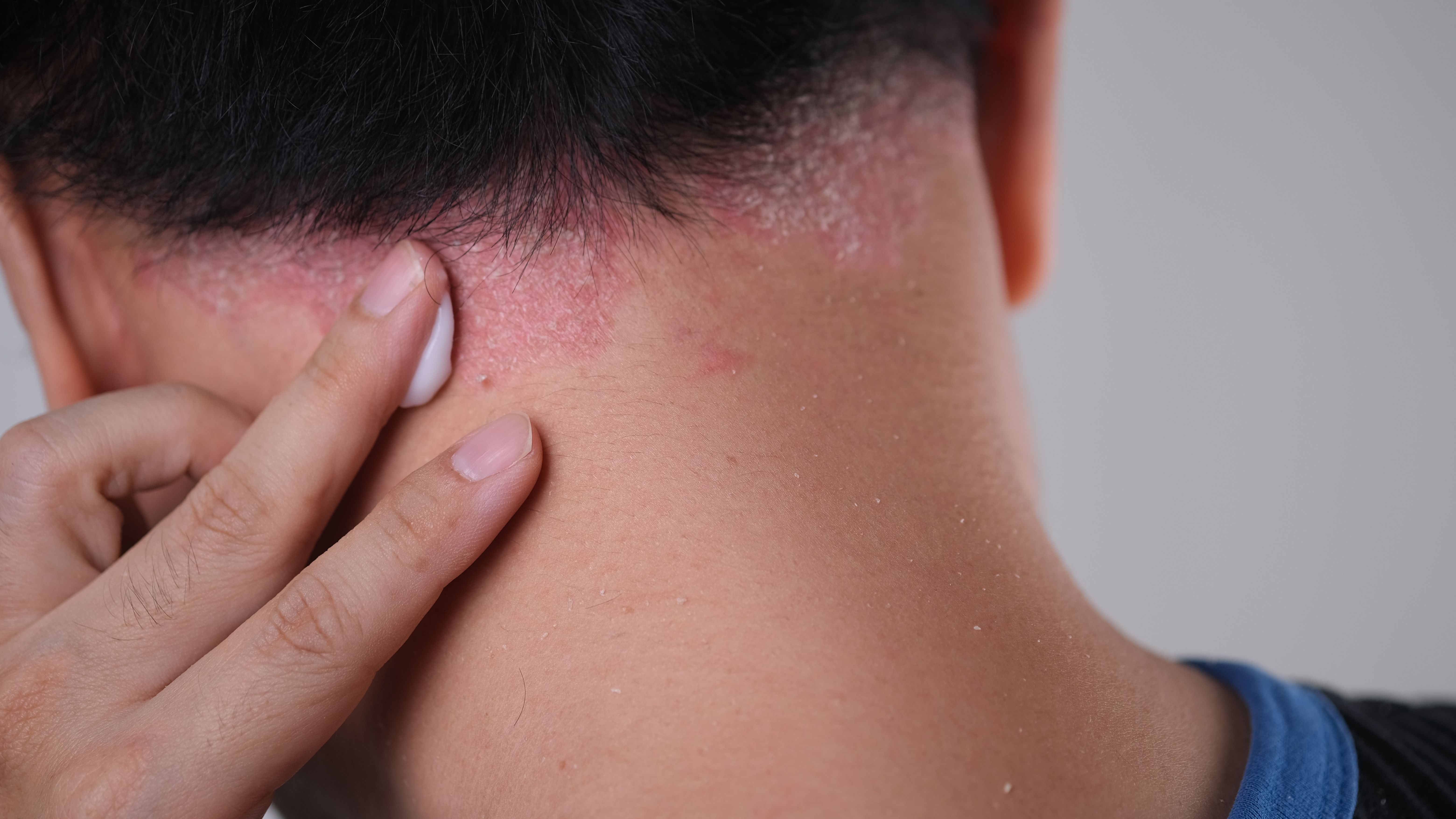 Understanding Scalp Psoriasis: Causes, Symptoms, and Treatment Options