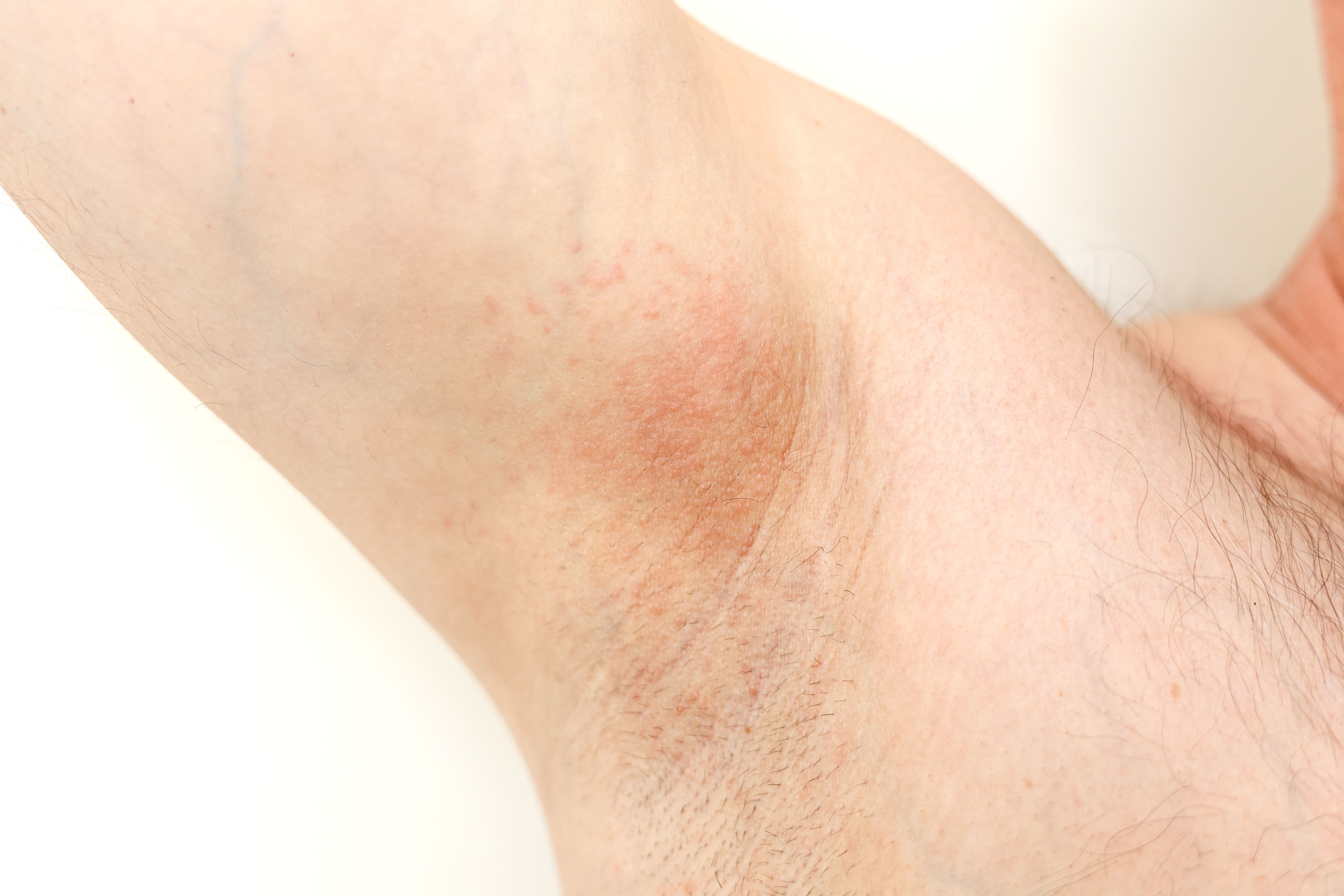 Understanding Inverse Psoriasis