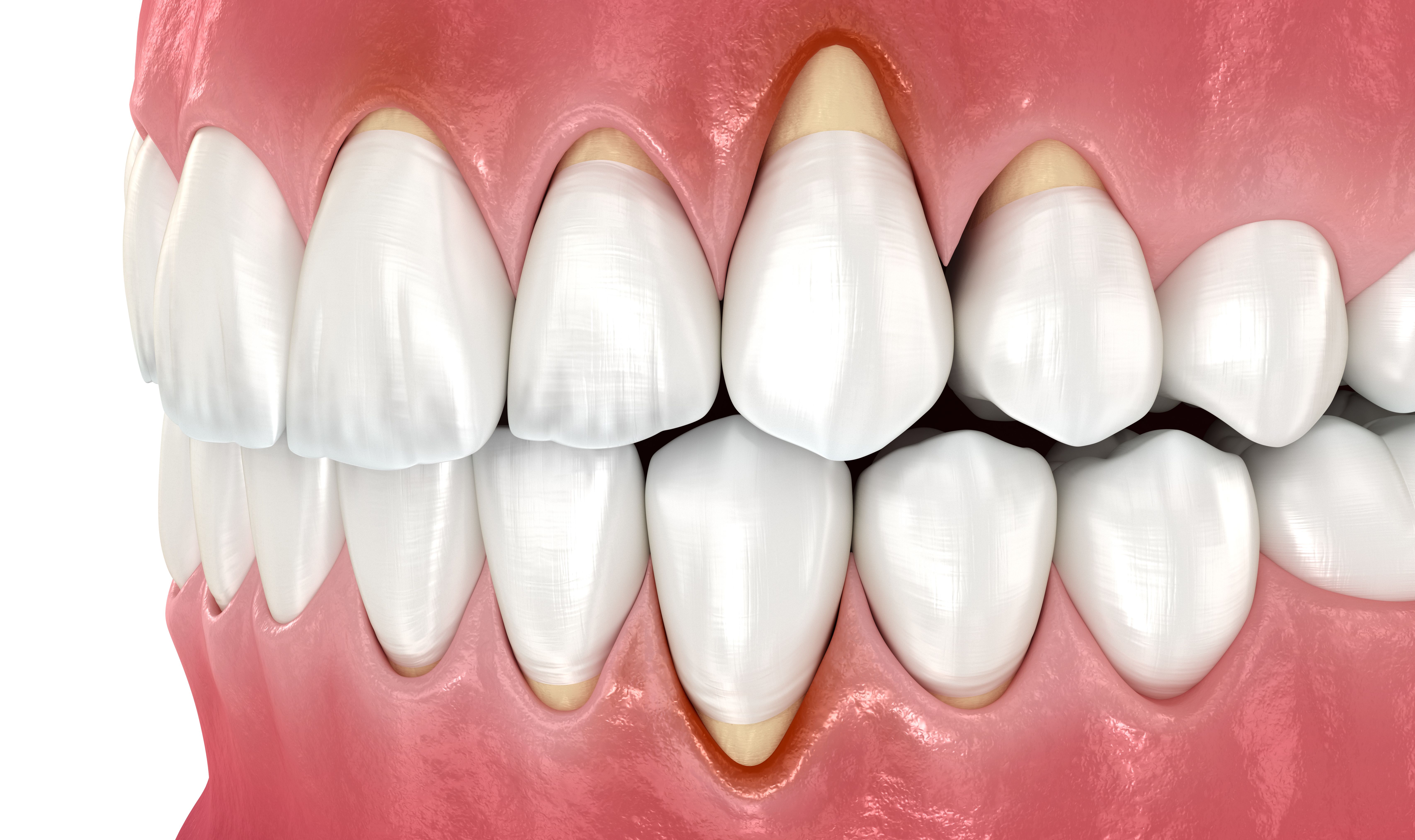 Understanding Tooth Recession: Causes and Prevention