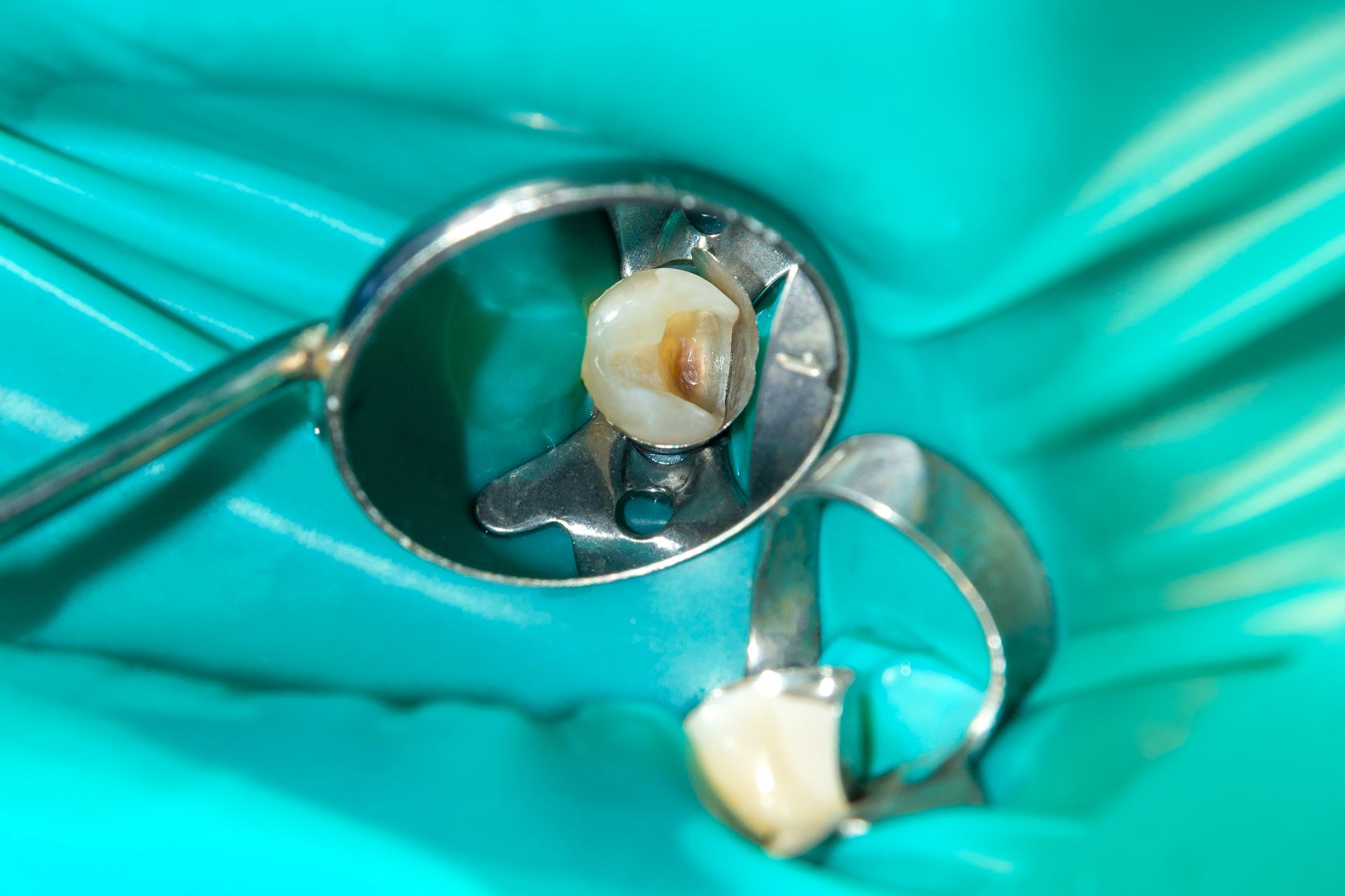 ¿Cuándo realizar una endodoncia?